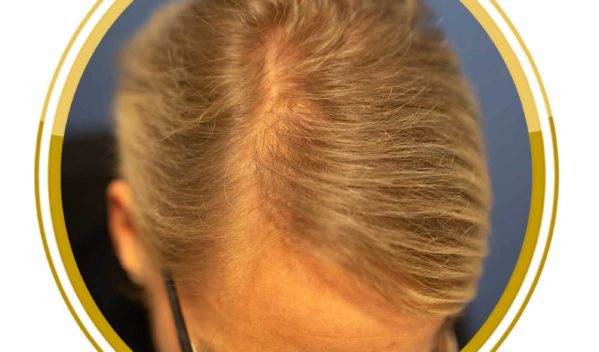 Erfahrungsbericht: Eigenbluttherapie bei Haarausfall - Dr. Dr. Stein ...